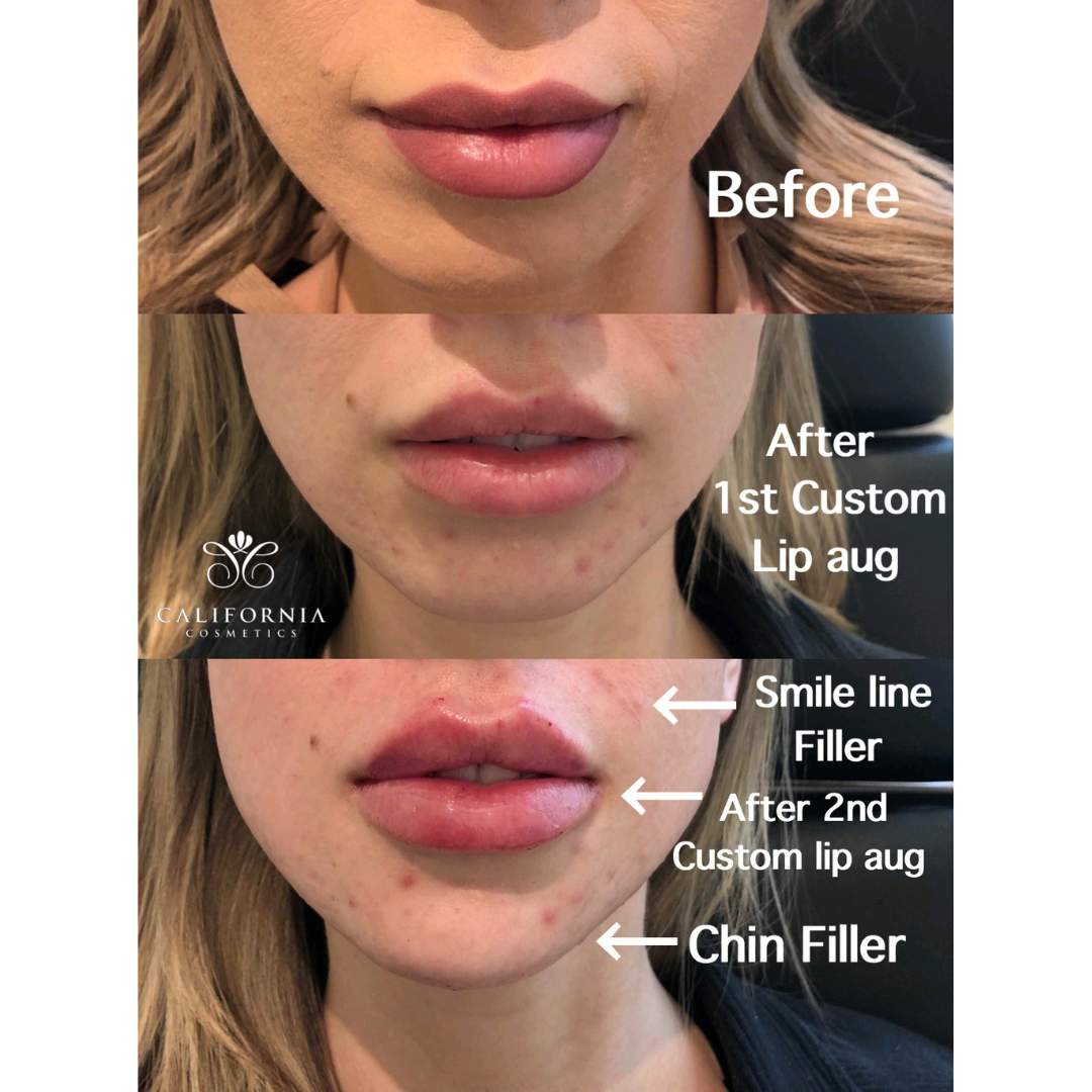 Book Custom Lip Augmentation Package | California Cosmetics