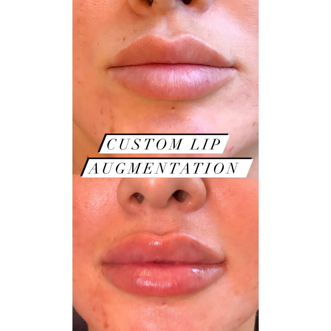 Book Custom Lip Augmentation Package | California Cosmetics