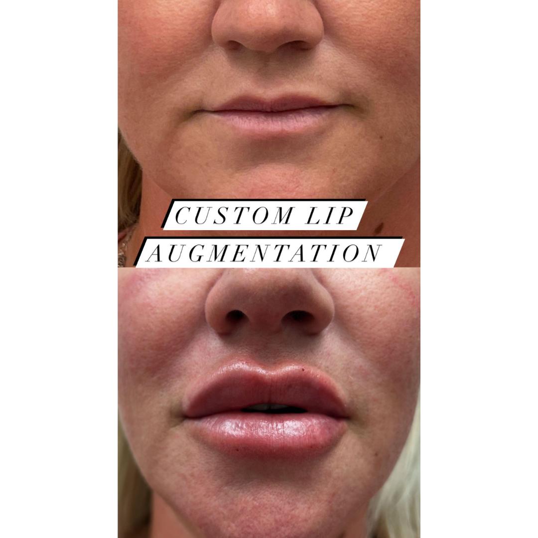 Book Custom Lip Augmentation Package | California Cosmetics