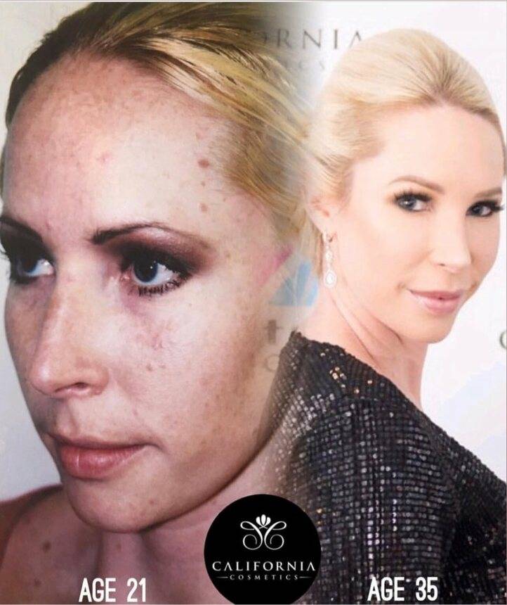 Cutera® IPL Photofacial Treatments in Newport & Corona | California ...