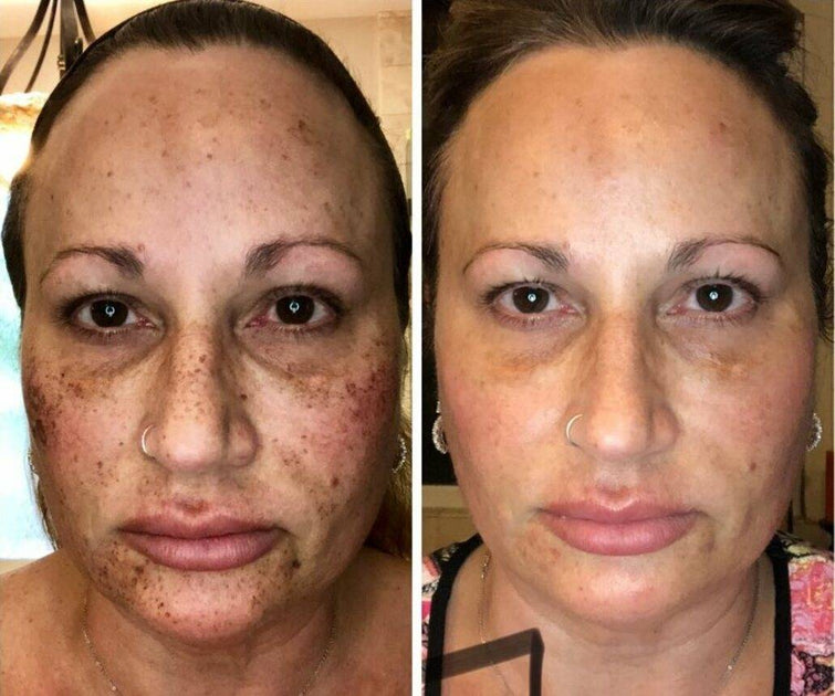 Cutera® IPL Photofacial Treatments in Newport & Corona | California ...