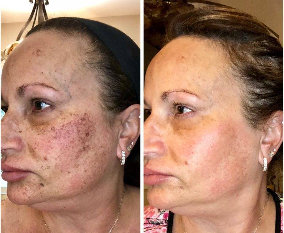 Cutera® IPL Photofacial Treatments in Newport & Corona | California ...