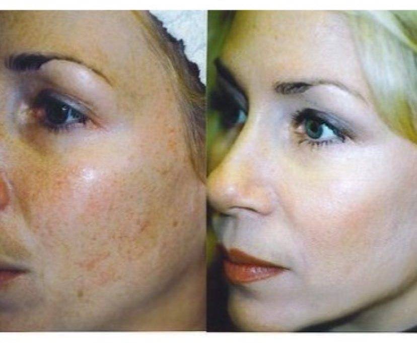 Cutera® IPL Photofacial Treatments in Newport & Corona | California ...