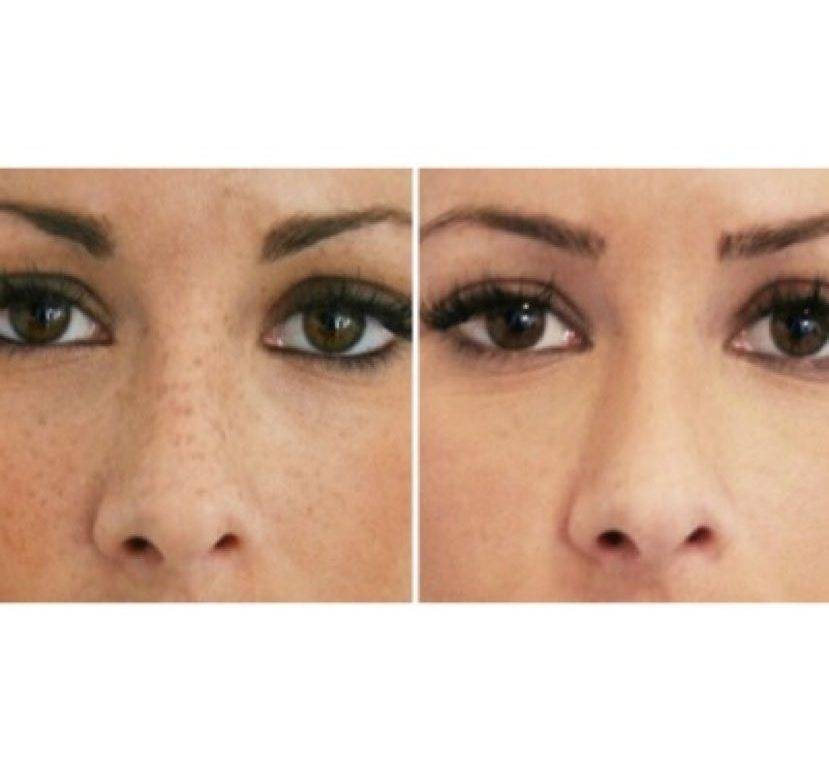 Cutera® IPL Photofacial Treatments in Newport & Corona | California ...