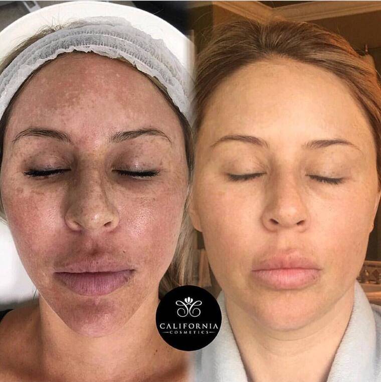 Cutera® IPL Photofacial Treatments in Newport & Corona | California ...