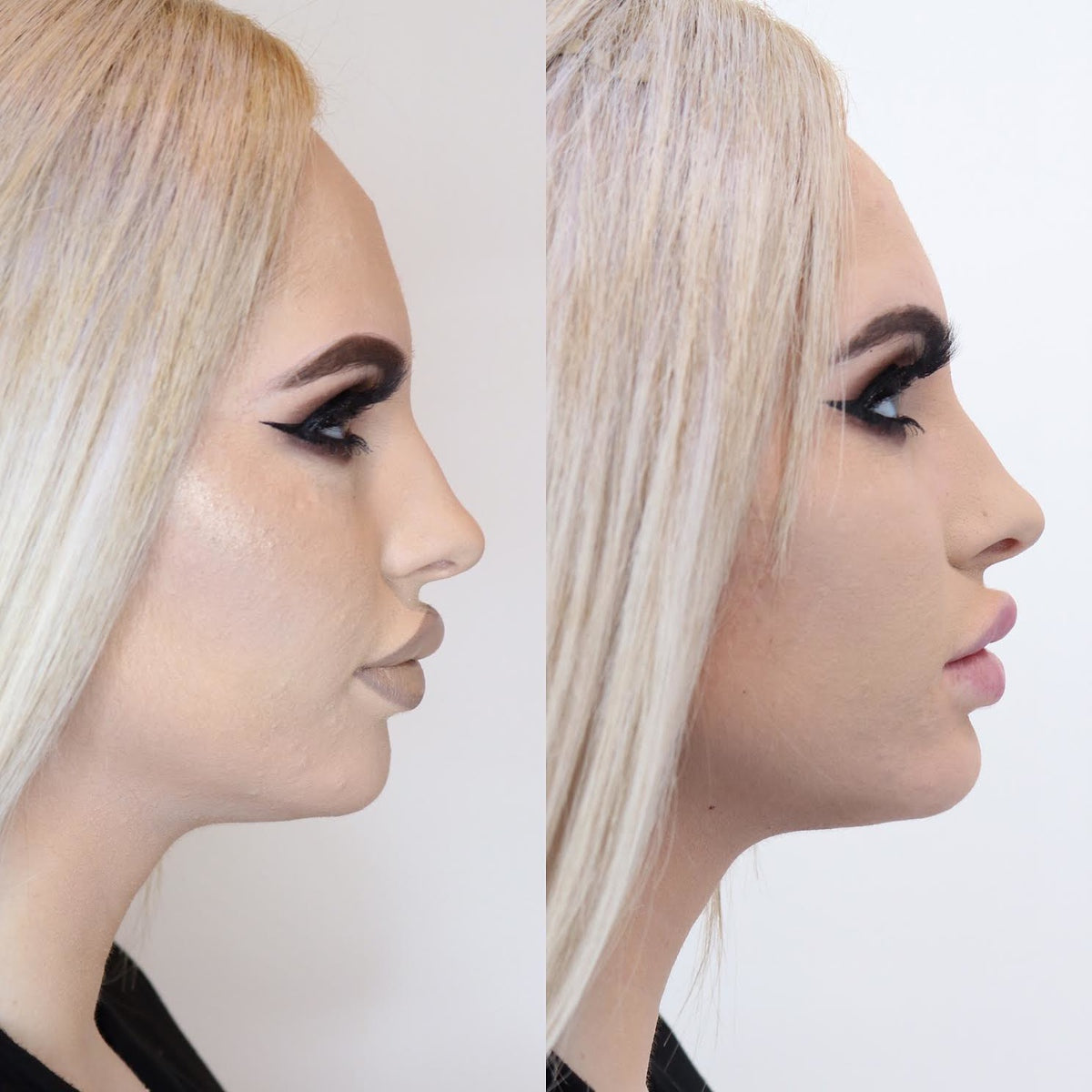 Non Surgical Chin Augmentation | Chin Fillers and Enhancement | Chin ...