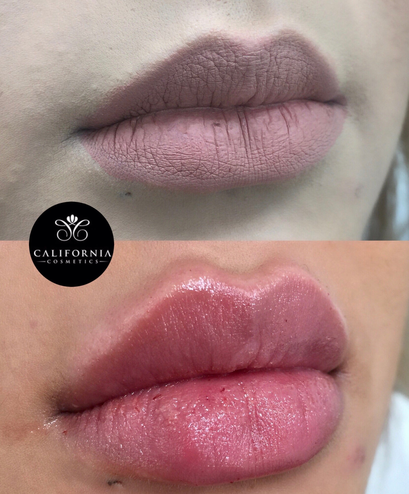 Custom Lip Augmentation | Lip Filler Injections | JUVÉDERM® | Newport ...