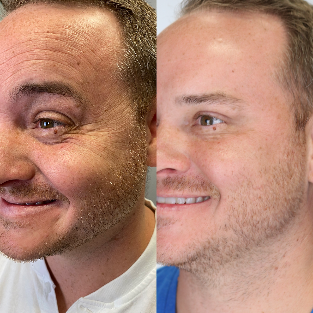 BOTOX® Injections | Lips | Frown Lines | Forehead | Armpits | Neck ...