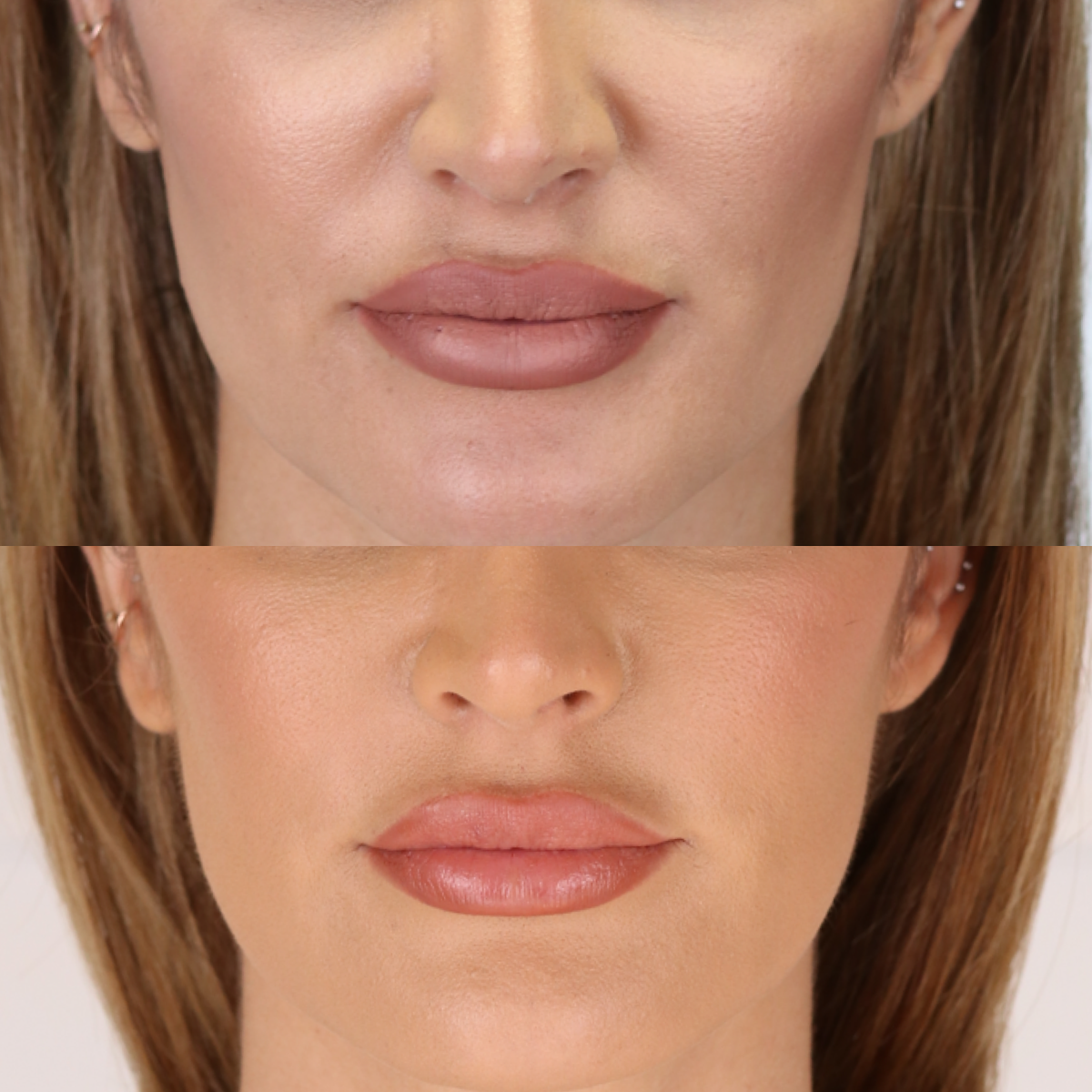 Smile Lines Treatment | Nasolabial Folds Filler | JUVÉDERM® Dermal ...