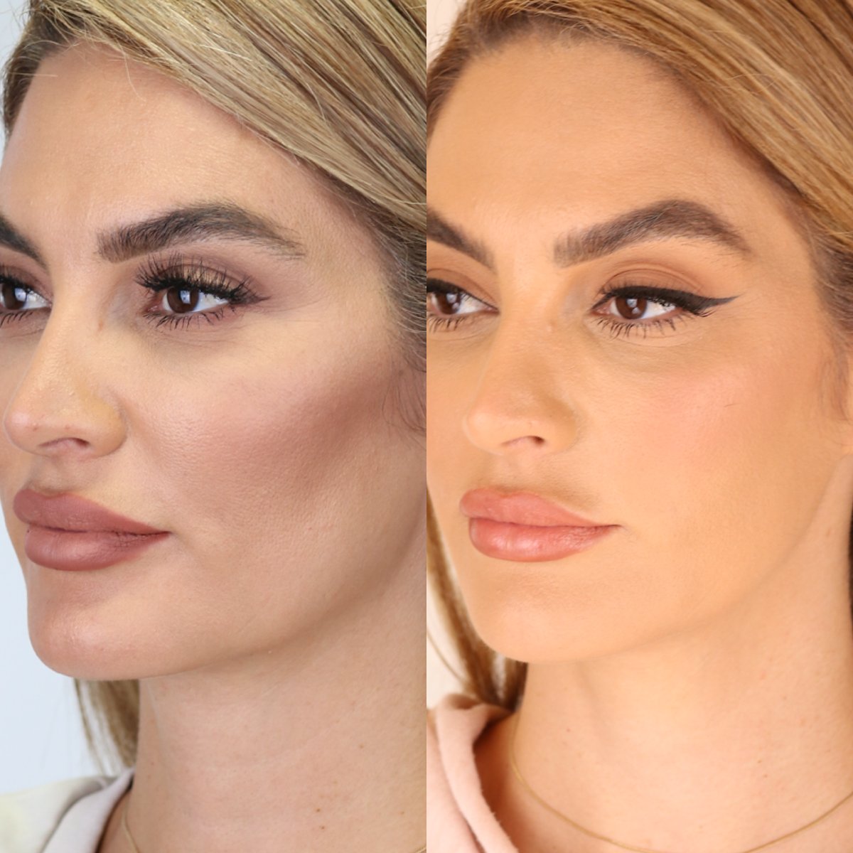 Smile Lines Treatment | Nasolabial Folds Filler | JUVÉDERM® Dermal ...