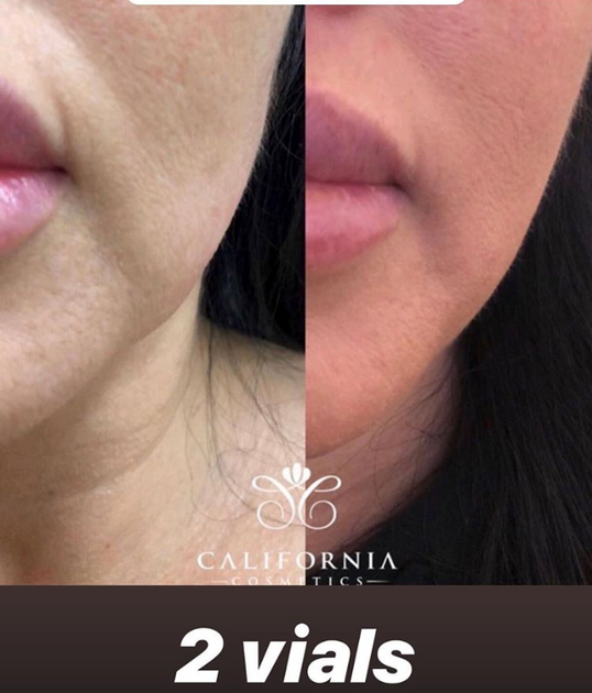 KYBELLA® Injections & Treatment | Double Chin Removal | Jowls | Stomach ...