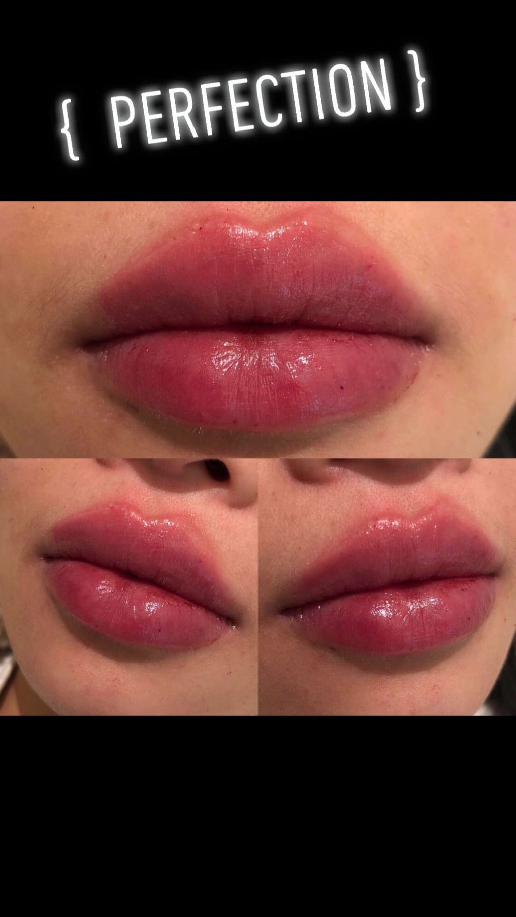 Lip Filler Injections | Lip Flip Procedure | Laugh Lines Treatment ...