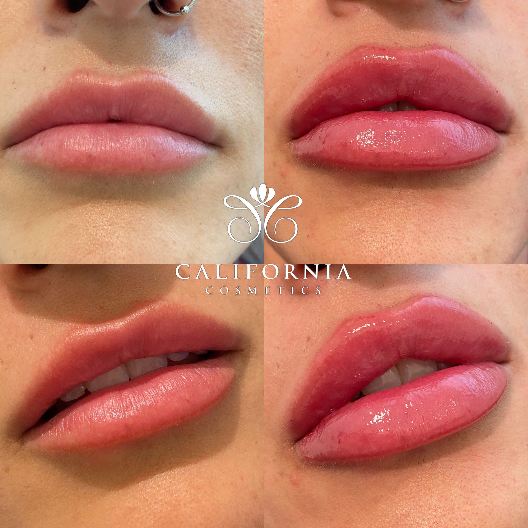 Lip Filler Injections | Lip Flip Procedure | Laugh Lines Treatment ...