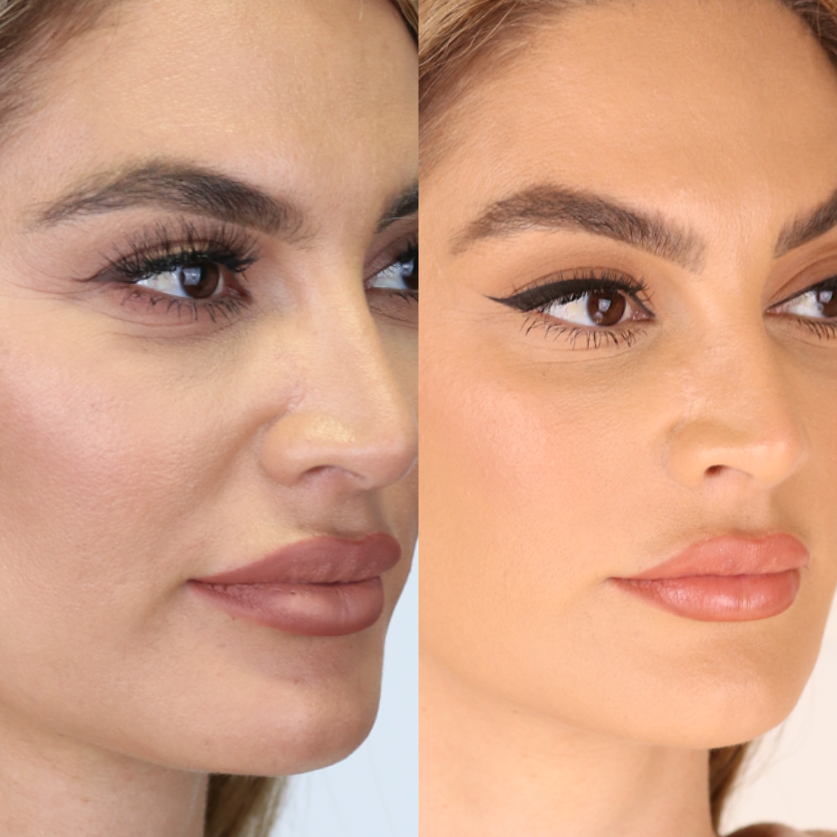 Smile Lines Treatment | Nasolabial Folds Filler | JUVÉDERM® Dermal ...