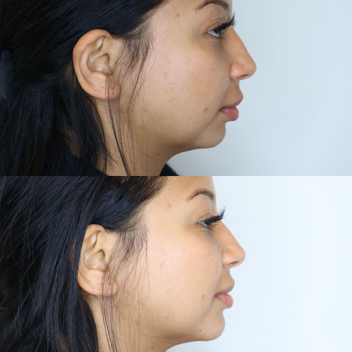 Non Surgical Chin Augmentation | Chin Fillers and Enhancement | Chin ...