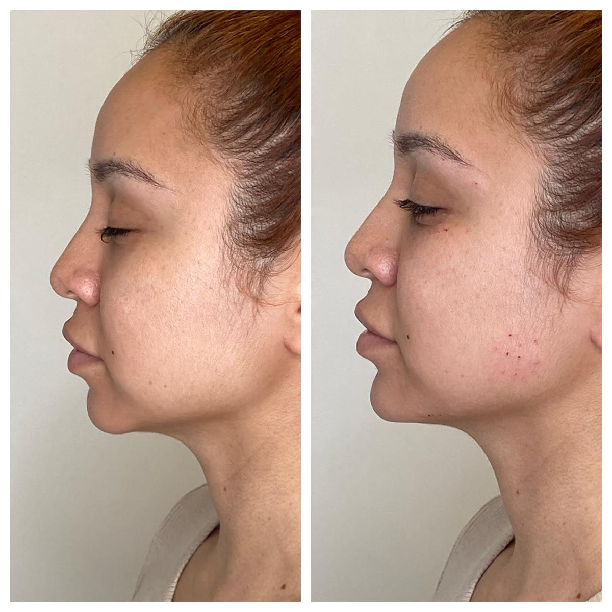 Non Surgical Chin Augmentation | Chin Fillers and Enhancement | Chin ...