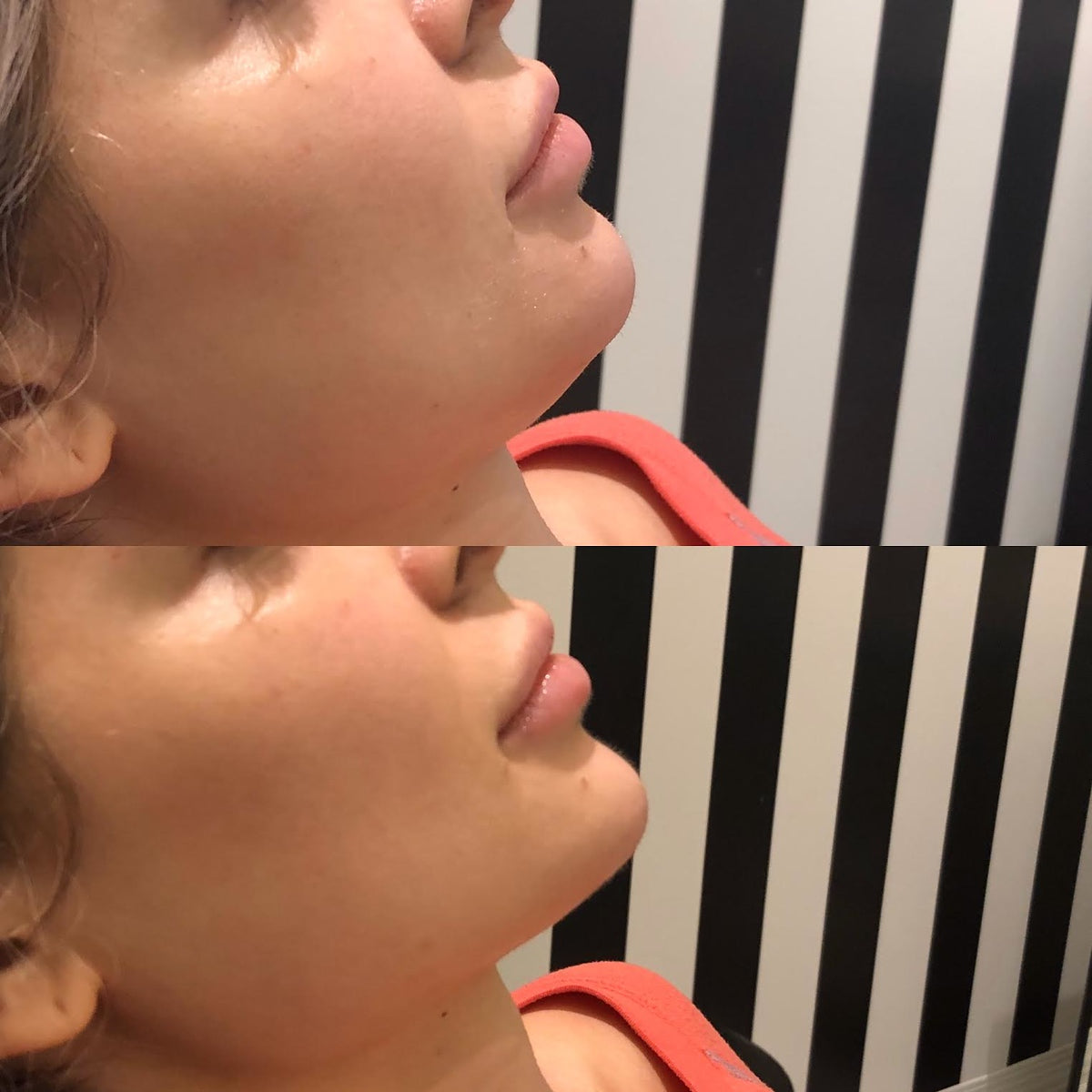 Non Surgical Chin Augmentation | Chin Fillers and Enhancement | Chin ...