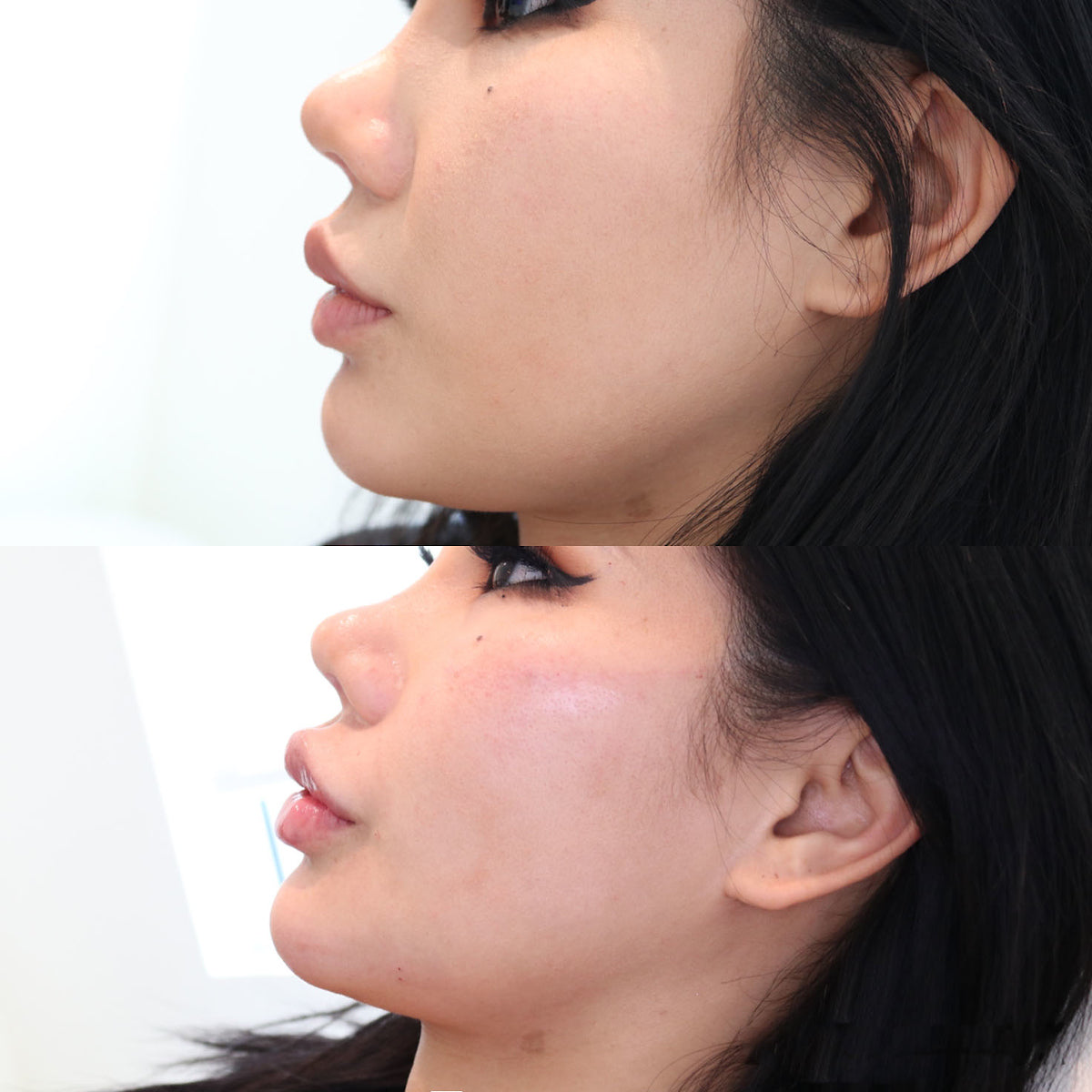 Non Surgical Chin Augmentation | Chin Fillers and Enhancement | Chin ...