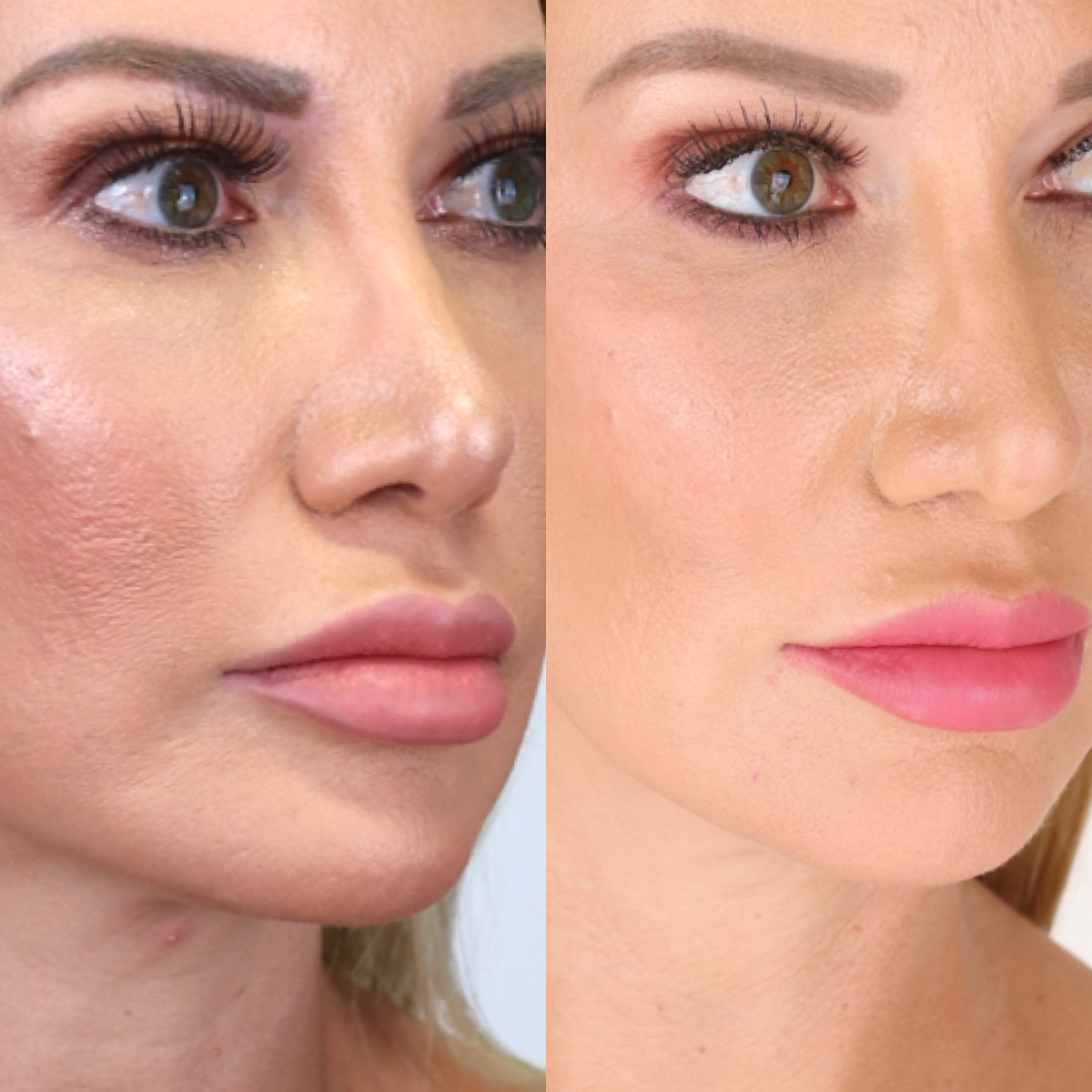 Smile Lines Treatment | Nasolabial Folds Filler | JUVÉDERM® Dermal ...