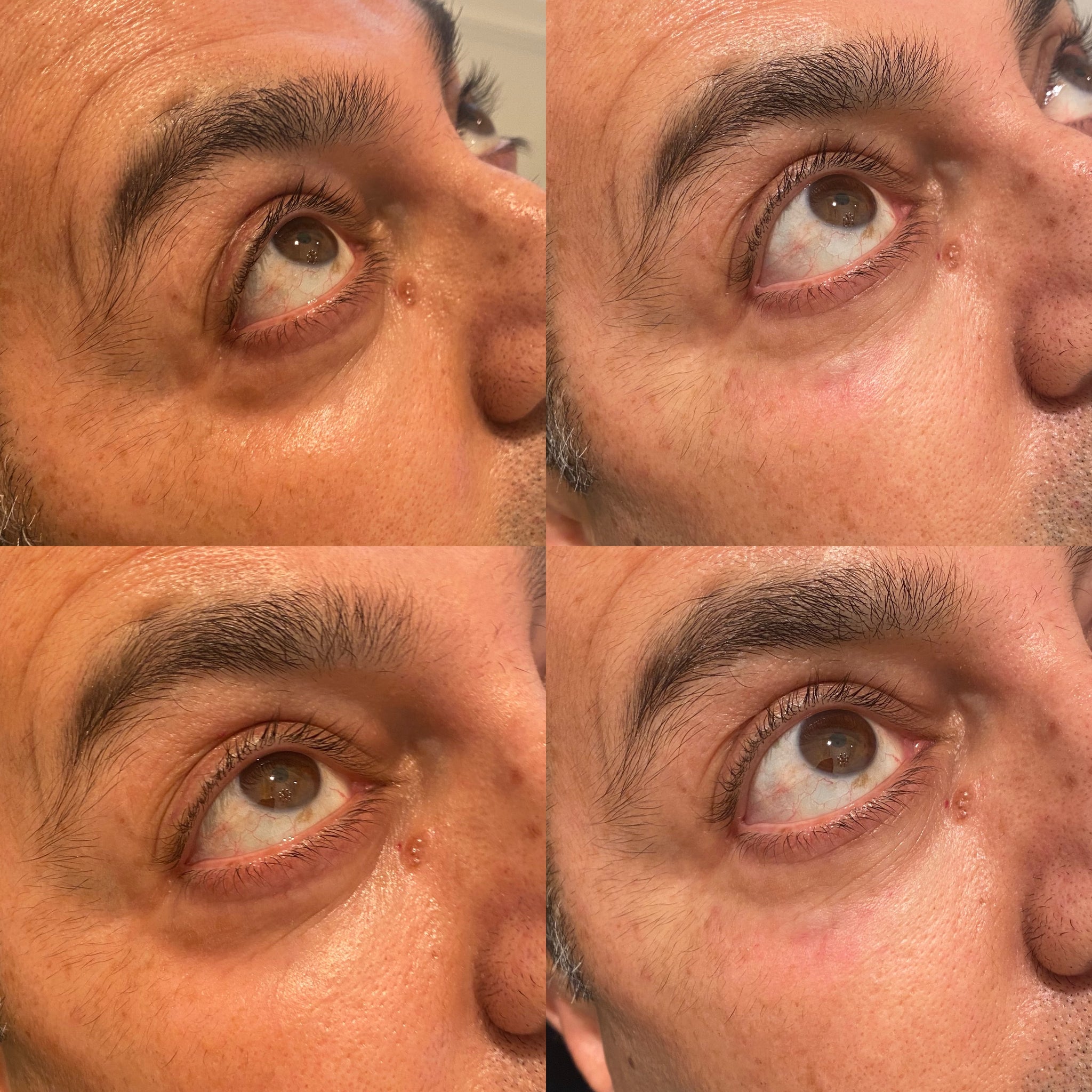 Tear Trough Fillers | Under Eye Fillers | Eye Bag Treatment | BOTOX ...